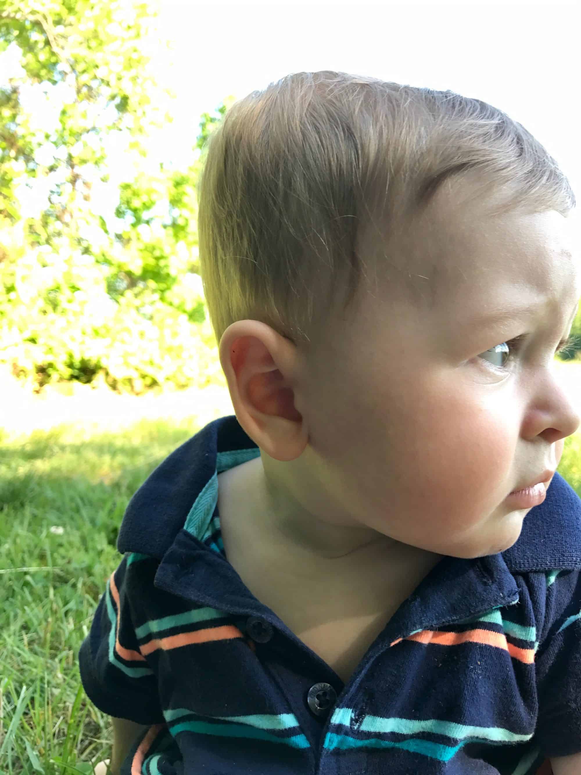 Why My Baby Wears a Cranial Helmet